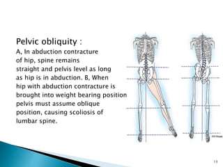 Iliotibial band contracture | PPTX