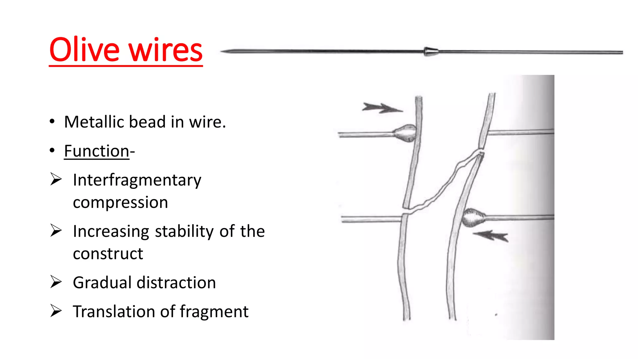 ILIZAROV EXTERNAL FIXATOR | PPTX
