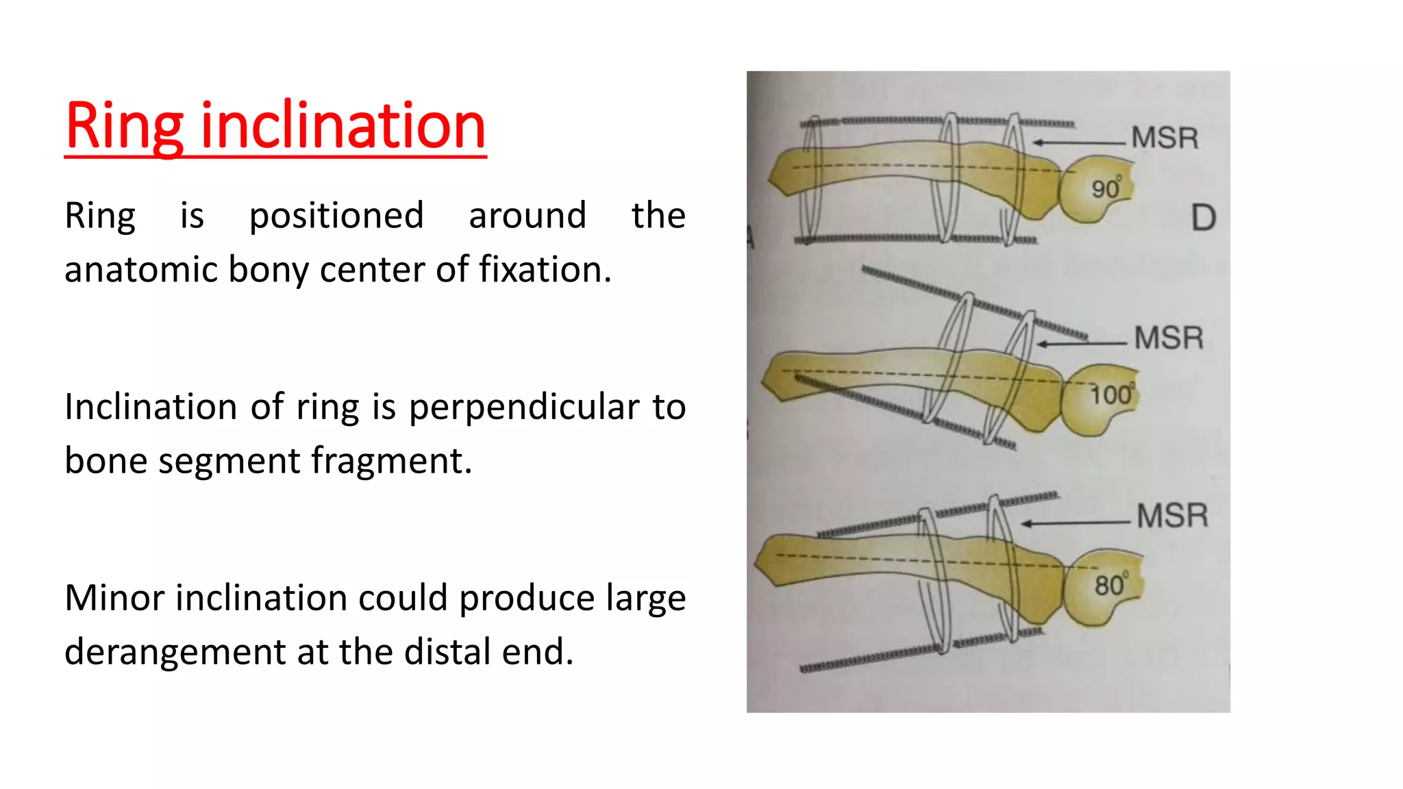 ILIZAROV EXTERNAL FIXATOR | PPTX