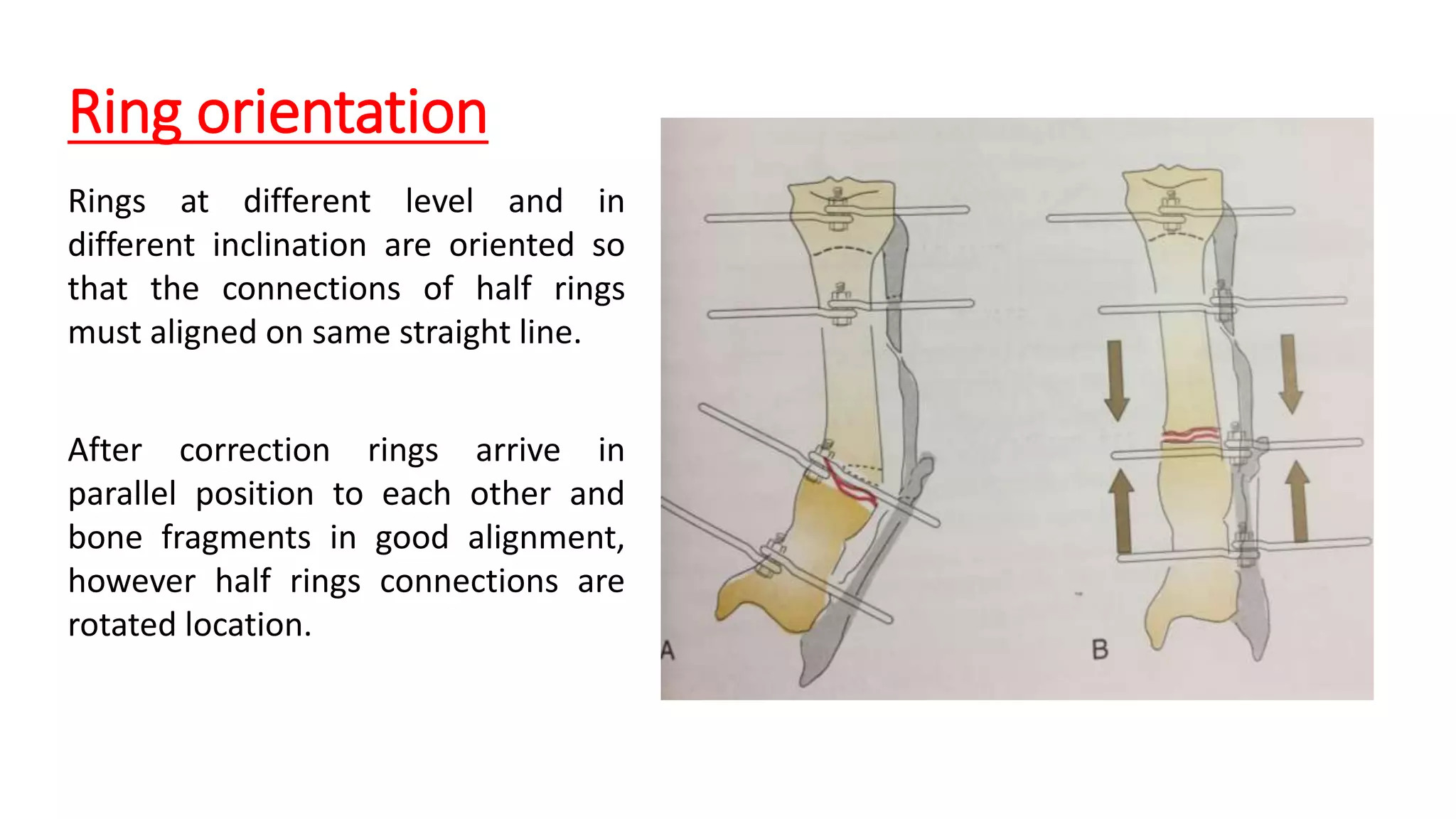 ILIZAROV EXTERNAL FIXATOR | PPTX
