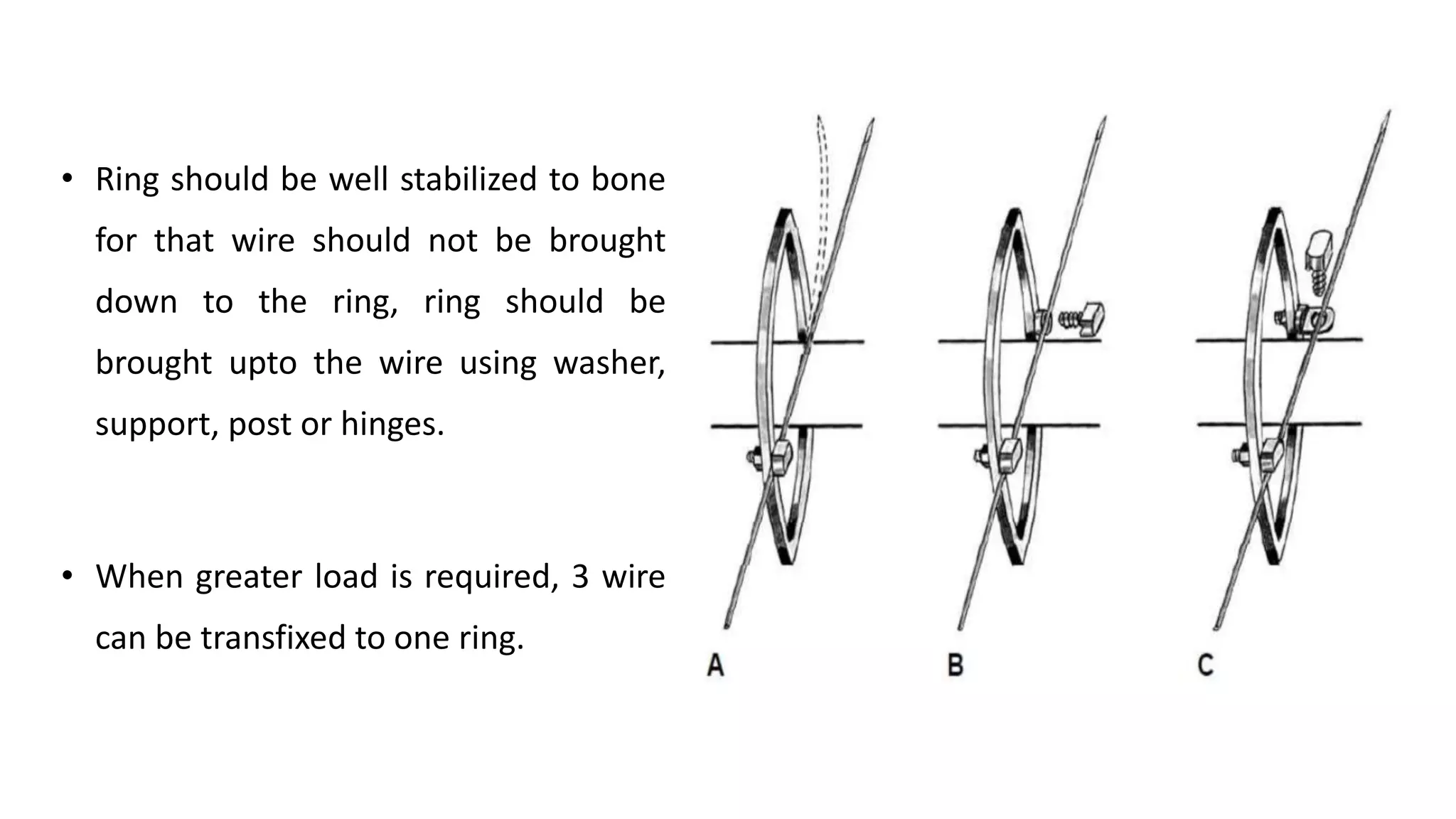 ILIZAROV EXTERNAL FIXATOR | PPTX