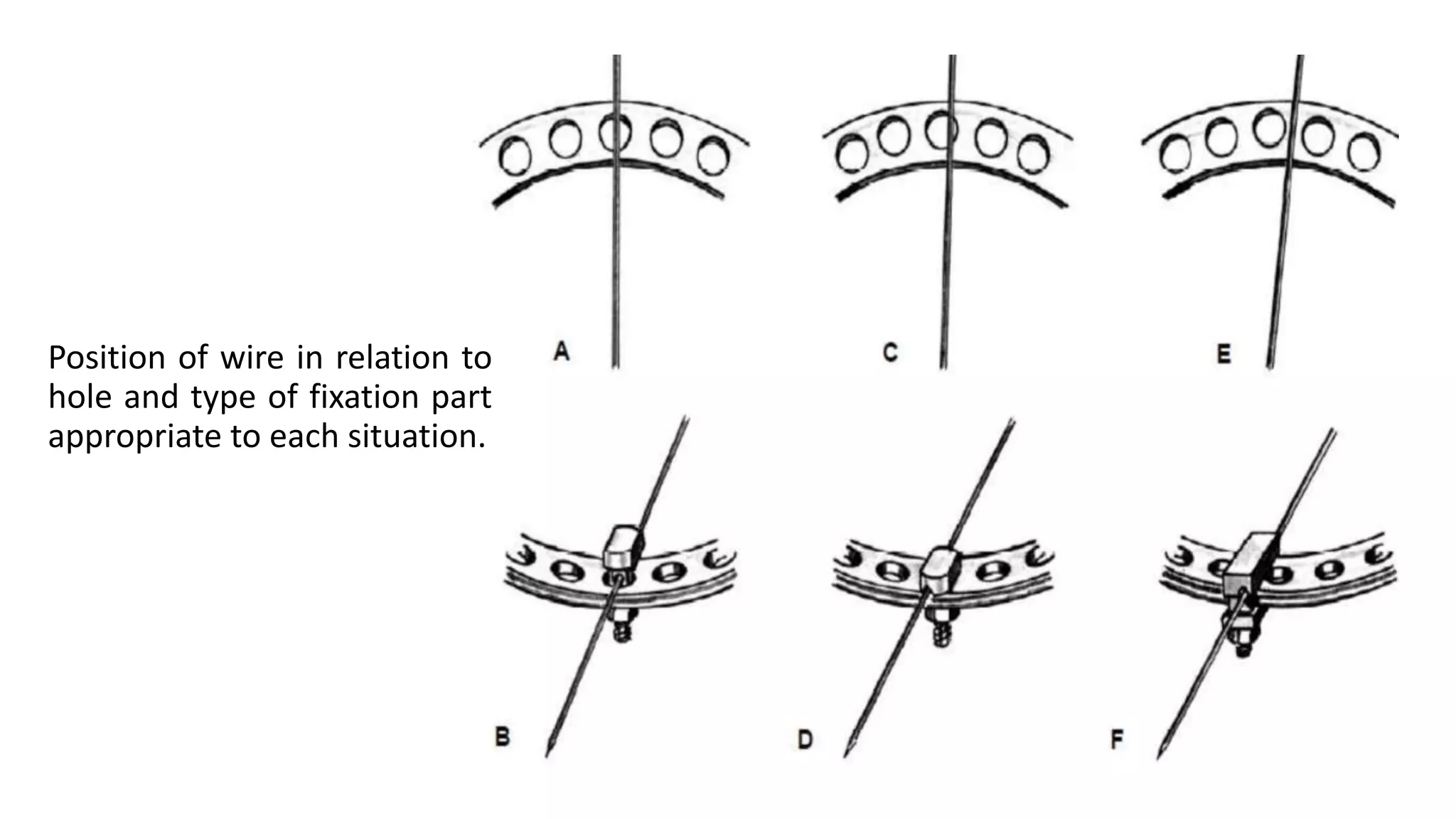 ILIZAROV EXTERNAL FIXATOR | PPTX