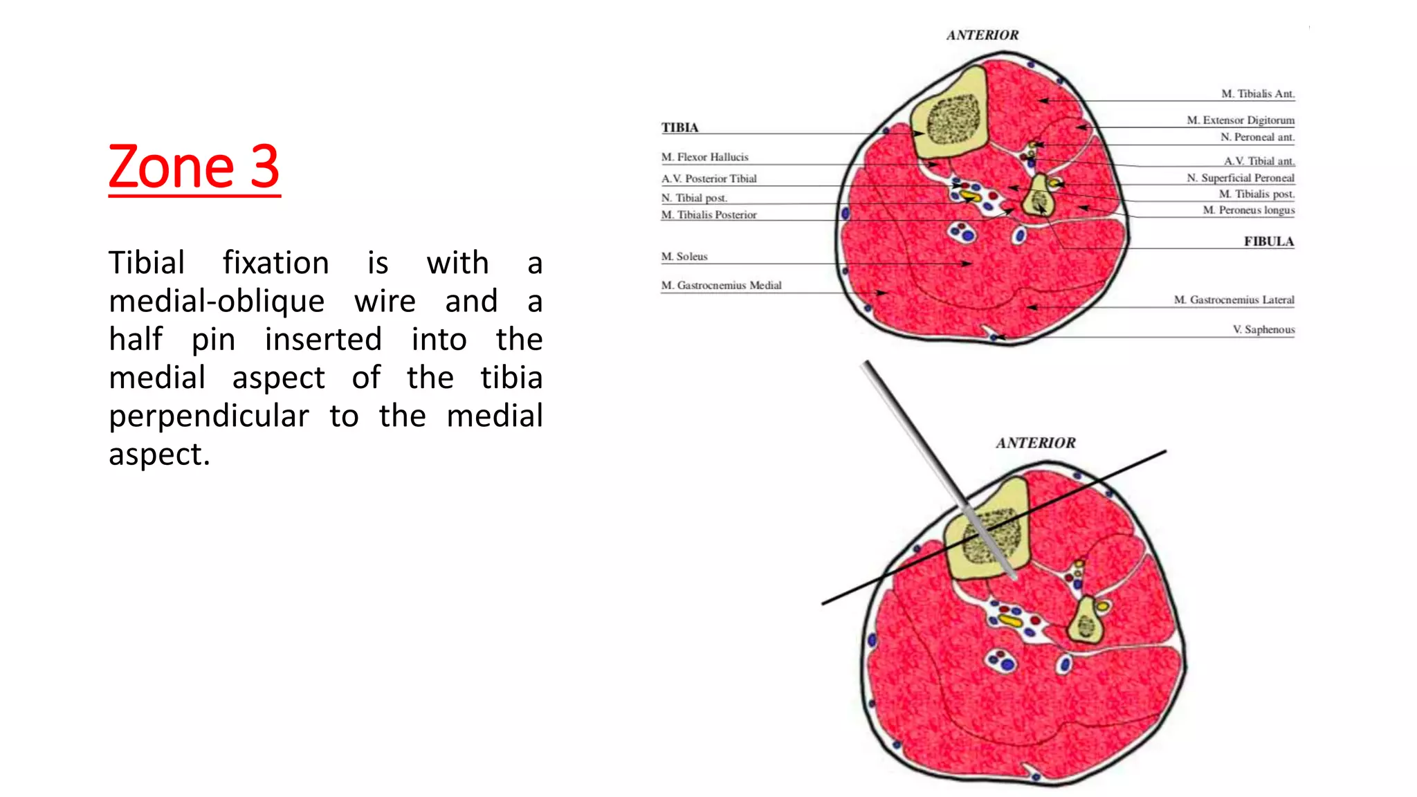 ILIZAROV EXTERNAL FIXATOR | PPTX