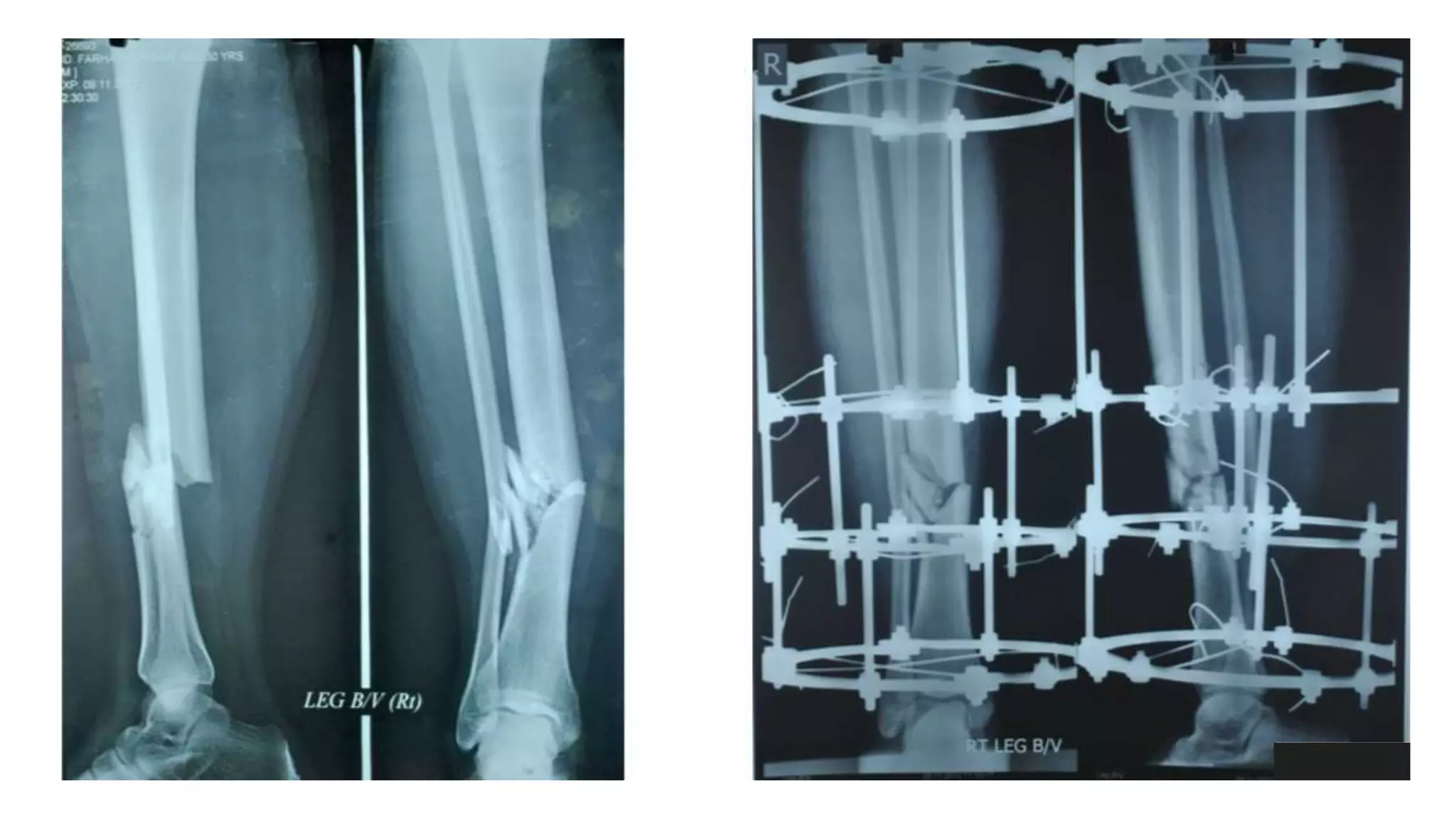 ILIZAROV EXTERNAL FIXATOR | PPTX