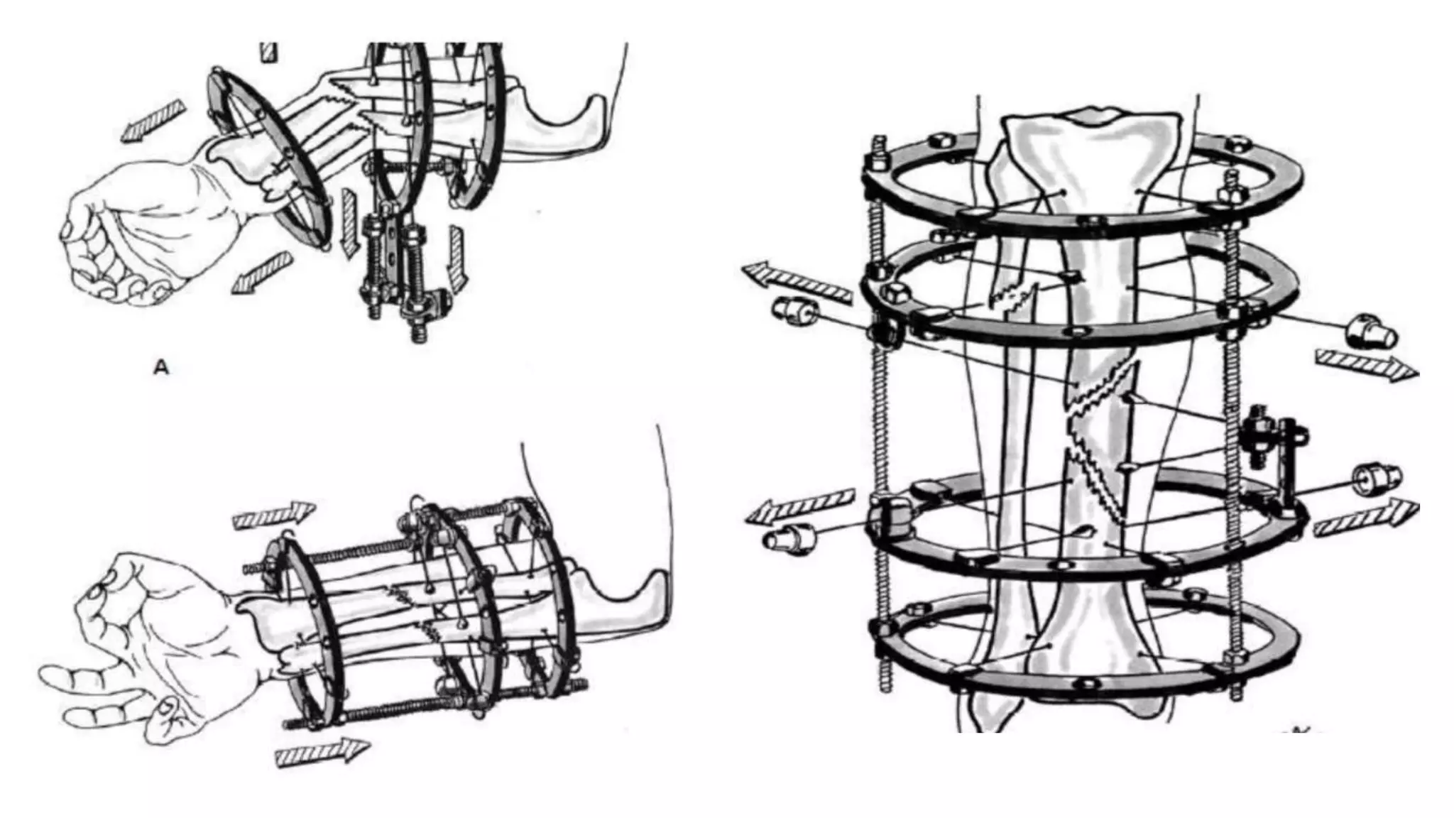 ILIZAROV EXTERNAL FIXATOR | PPTX