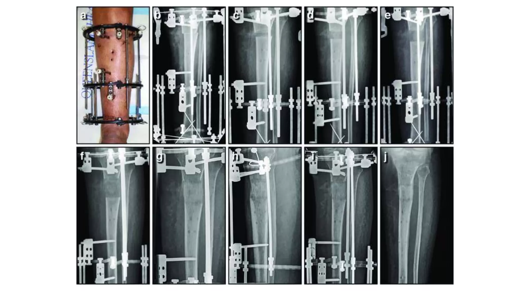 ILIZAROV EXTERNAL FIXATOR | PPTX