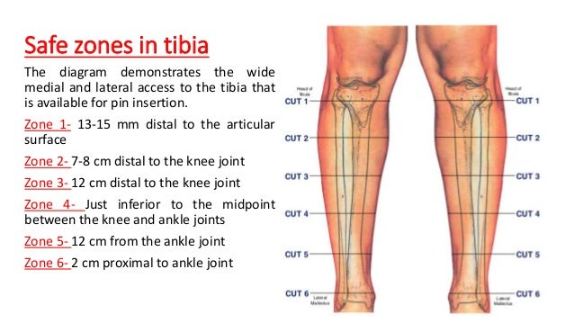 ILIZAROV EXTERNAL FIXATOR