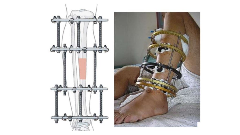 ILIZAROV EXTERNAL FIXATOR