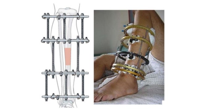 ILIZAROV EXTERNAL FIXATOR