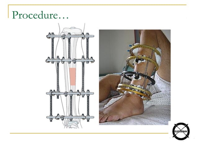Ilizarov External fixator | PPT
