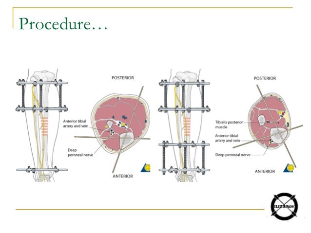 Ilizarov External fixator