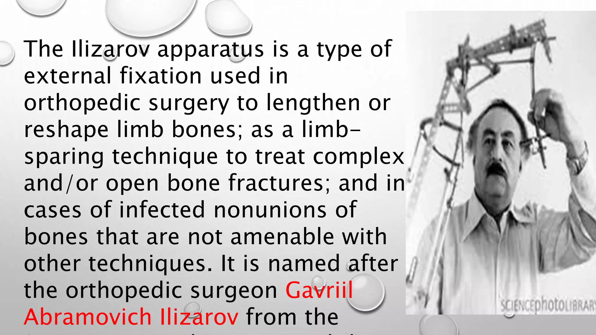 Ilizarov external fixator | PPTX