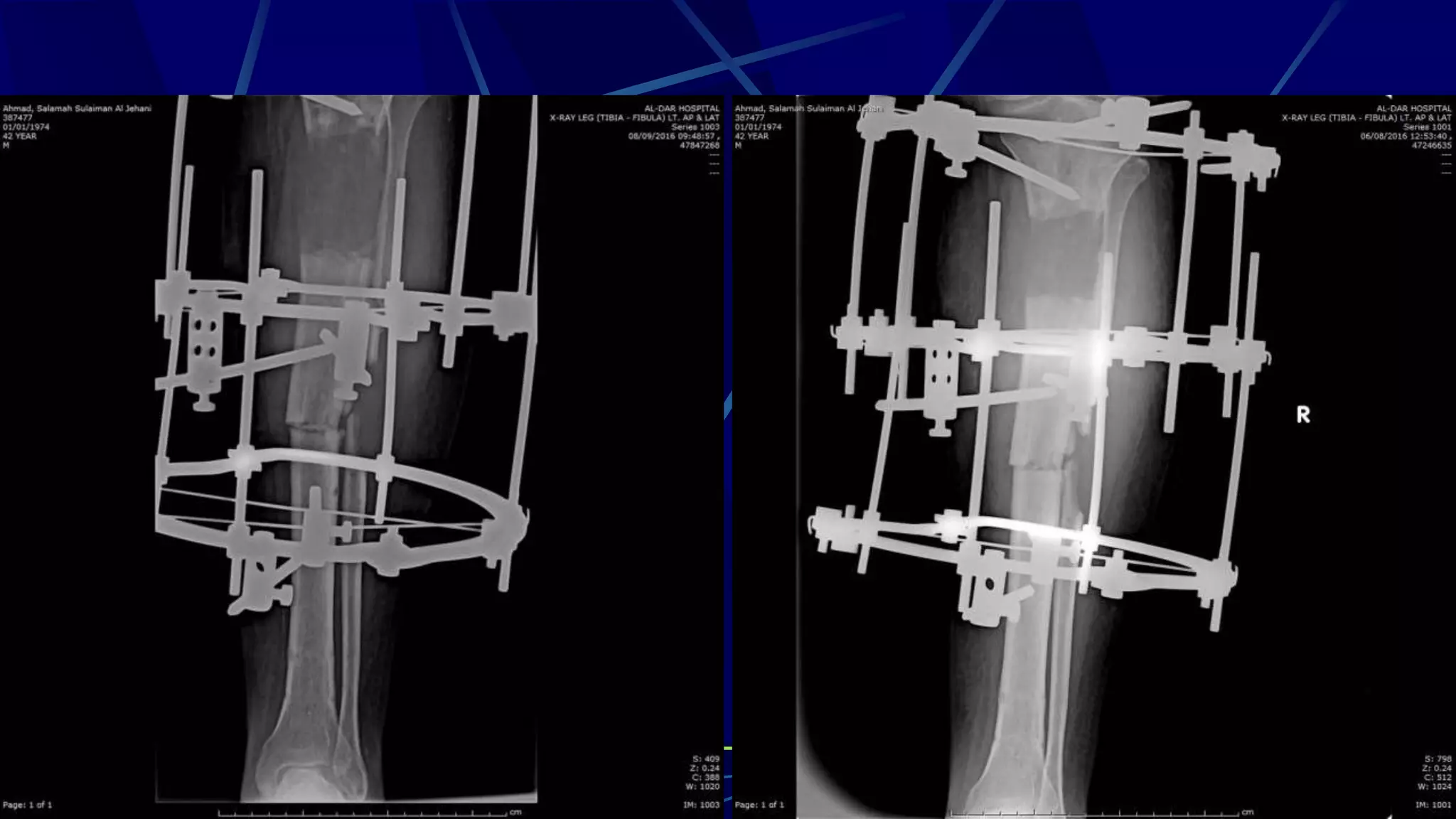 Ilizarov external fixator | PPTX