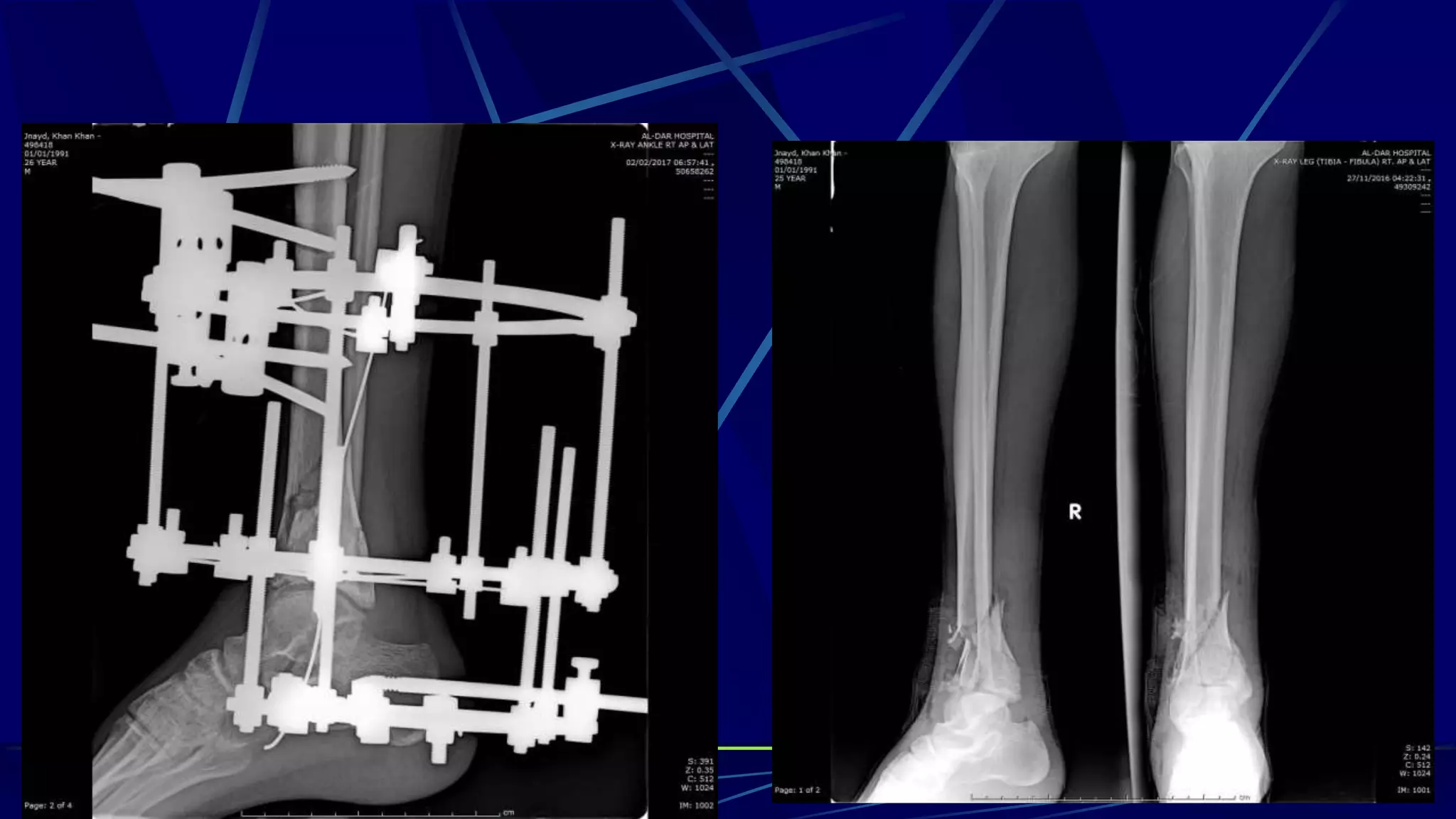 Ilizarov external fixator | PPTX