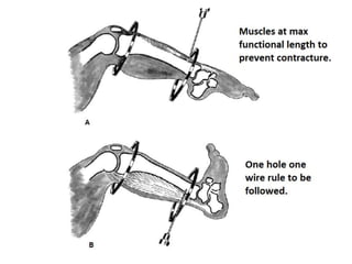 Ilizarov frame assemblage | PPTX
