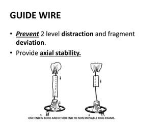 Ilizarov frame assemblage | PPTX