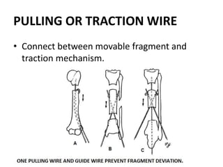 Ilizarov frame assemblage | PPTX
