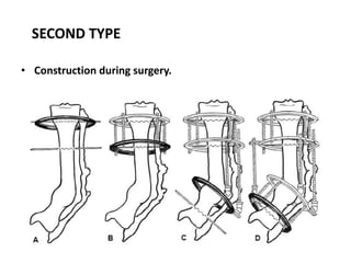 Ilizarov frame assemblage | PPTX