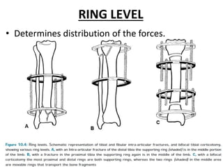 Ilizarov frame assemblage | PPTX