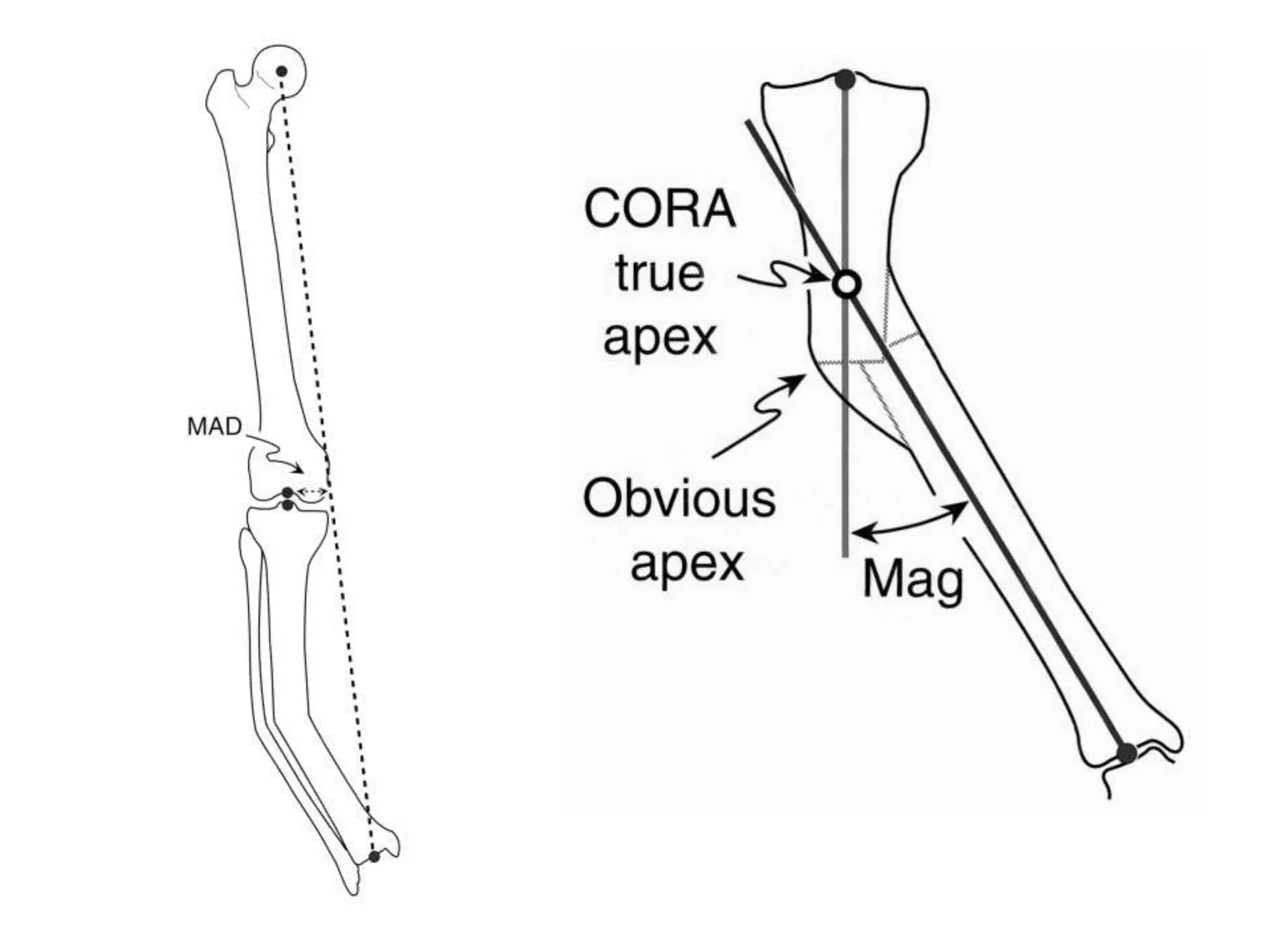 Ilizarov principles of deformity correction.pptx