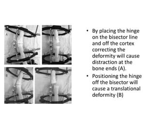 Ilizarov principles of deformity correction.pptx