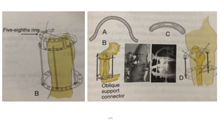 Ilizarov ring fixator | PPT