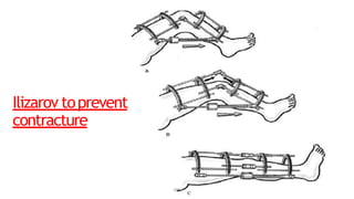 Ilizarov ring fixator | PPT