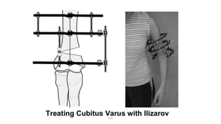 Ilizarov ring fixator | PPT