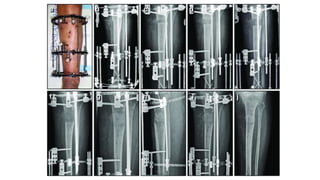 Ilizarov ring fixator | PPT