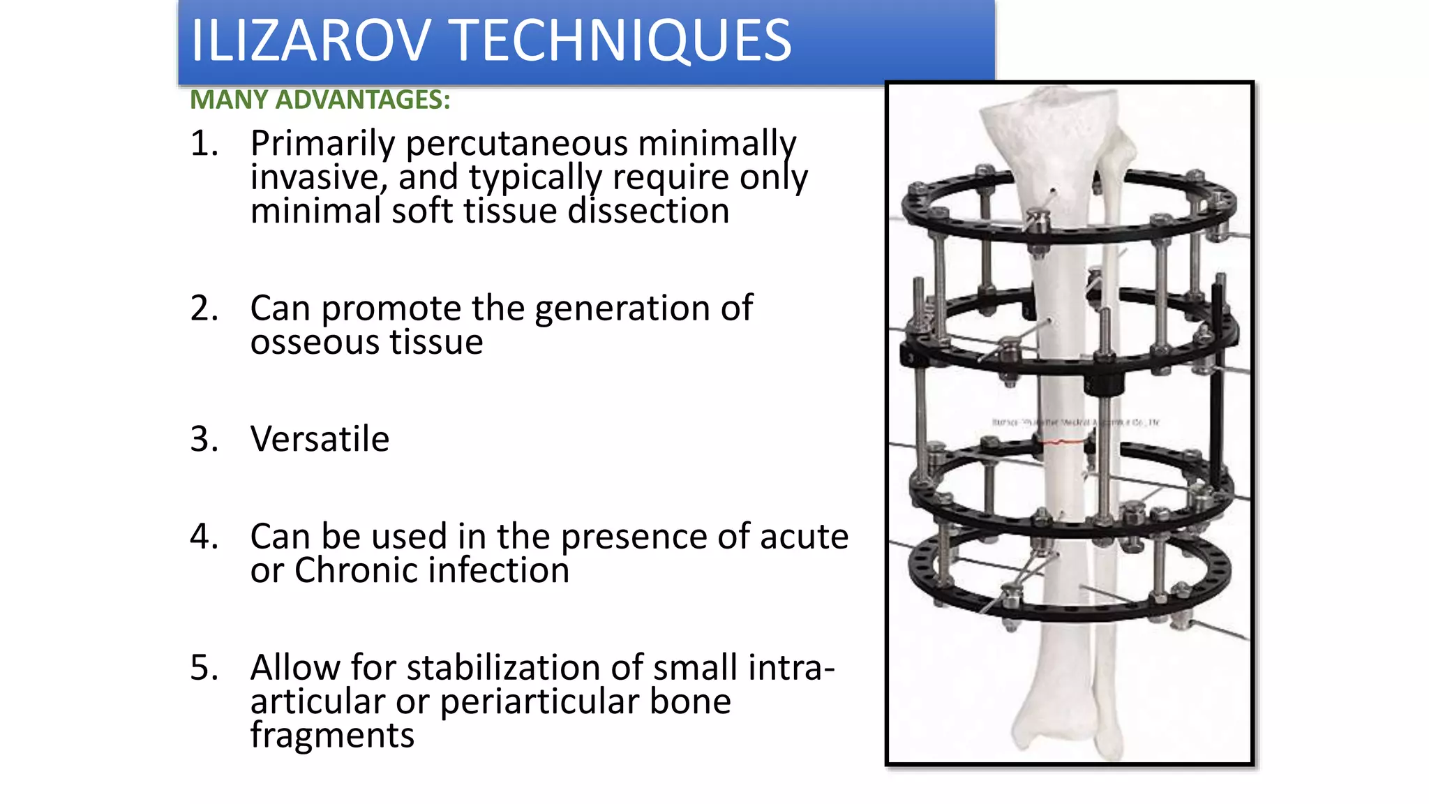 ILIZAROV RING FIXATOR.pptx | First Aid | Injuries