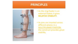 ILIZAROV RING FIXATOR.pptx