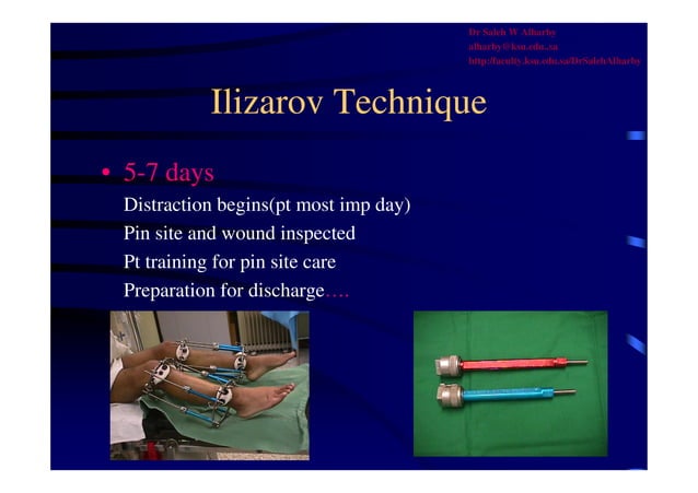 Ilizarov technique | PDF