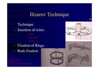 Ilizarov technique | PDF