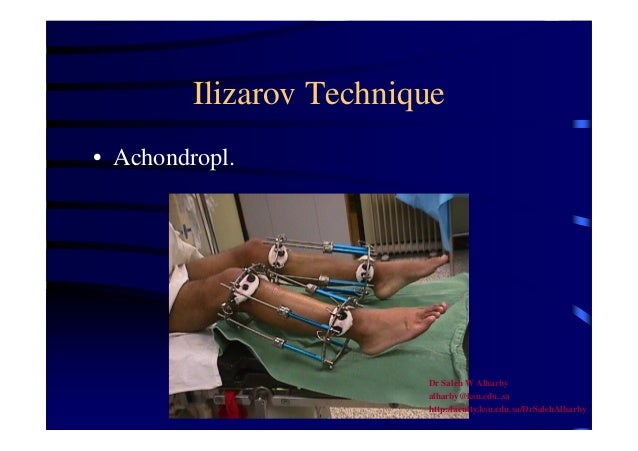 Ilizarov Technique Cholesterol Treatment Click Here