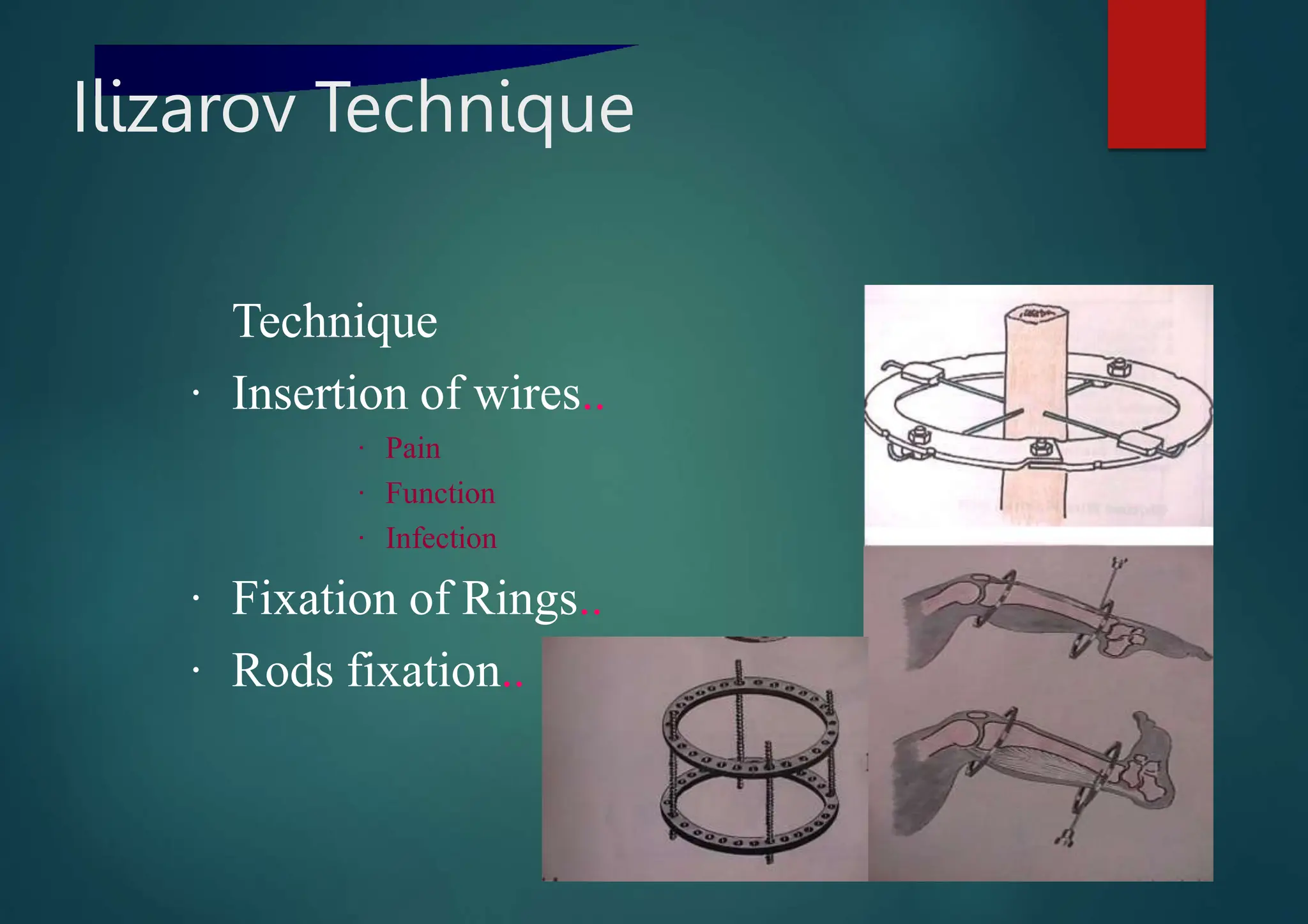 ilizarov technique.pptx