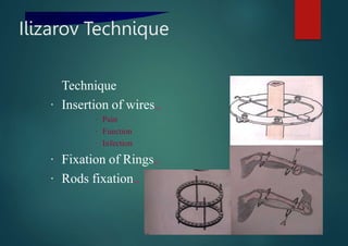 ilizarov technique.pptx