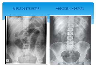 ILLEUS OBSTRUKTIF PPT.pptx