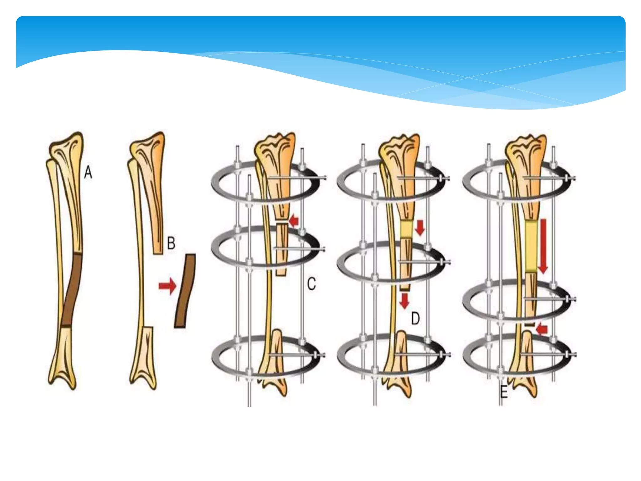Illizarov equipment set | PPT