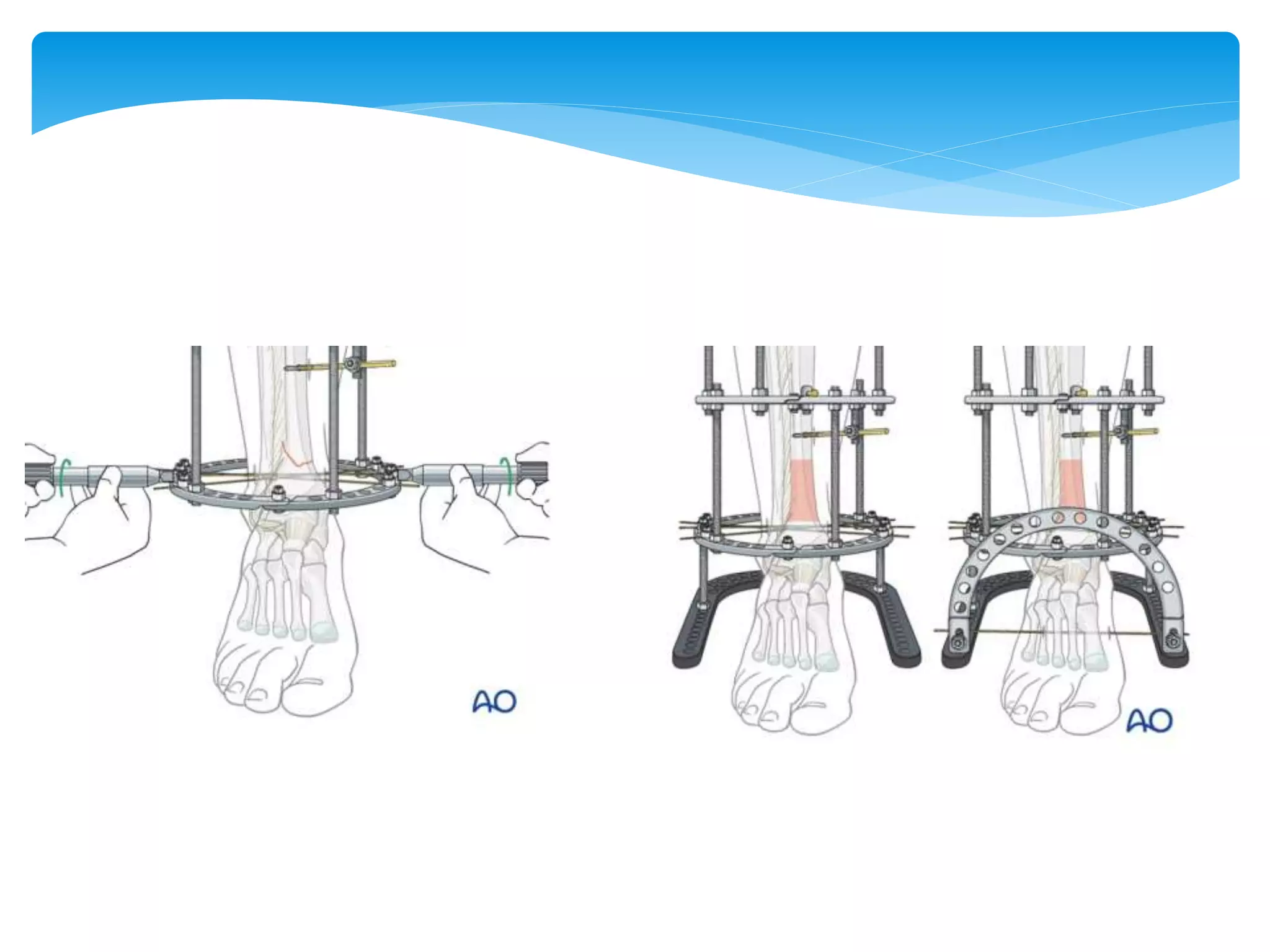 Illizarov equipment set | PPT