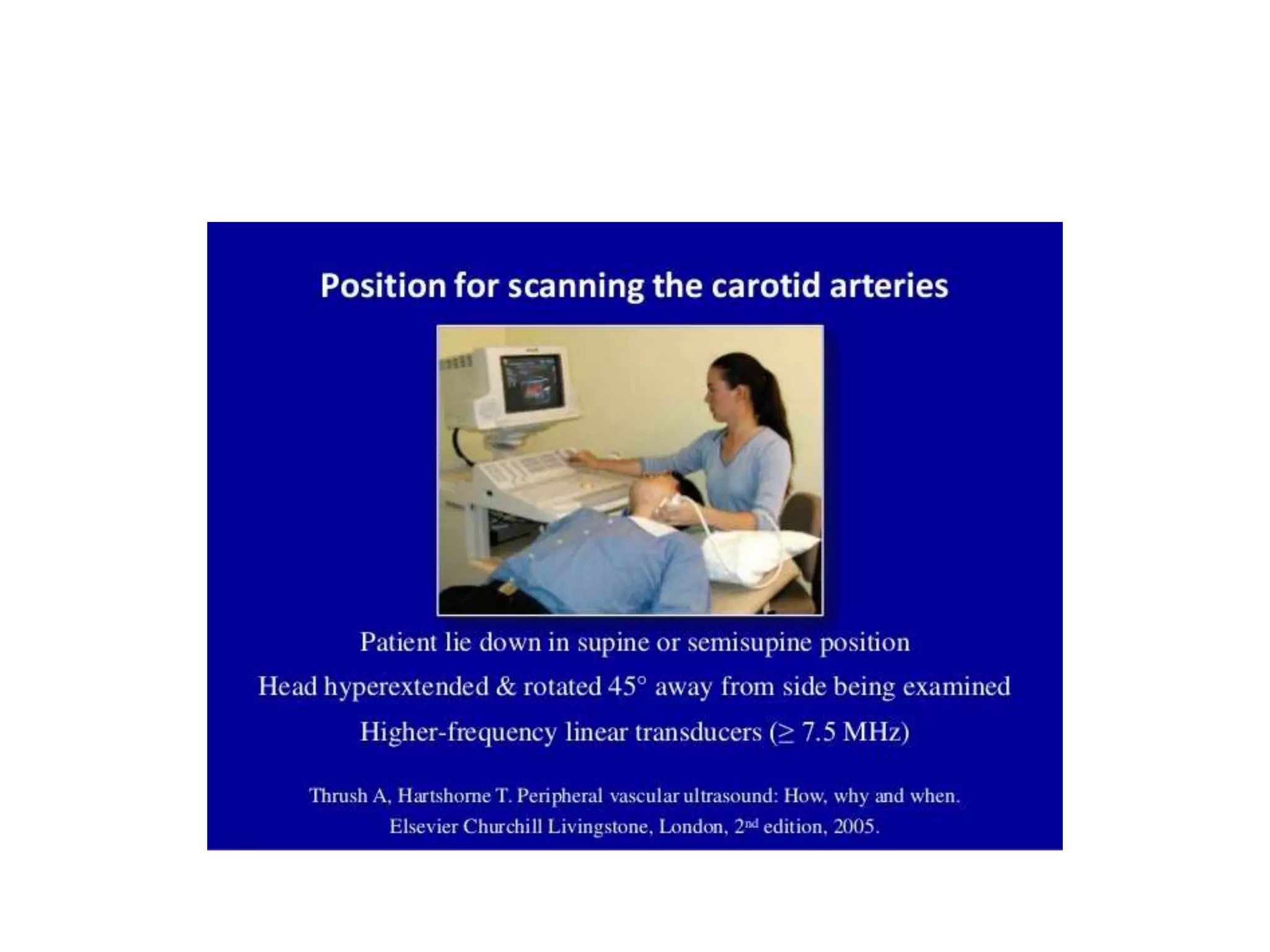 Illustrated carotid doppler 1 | PPT