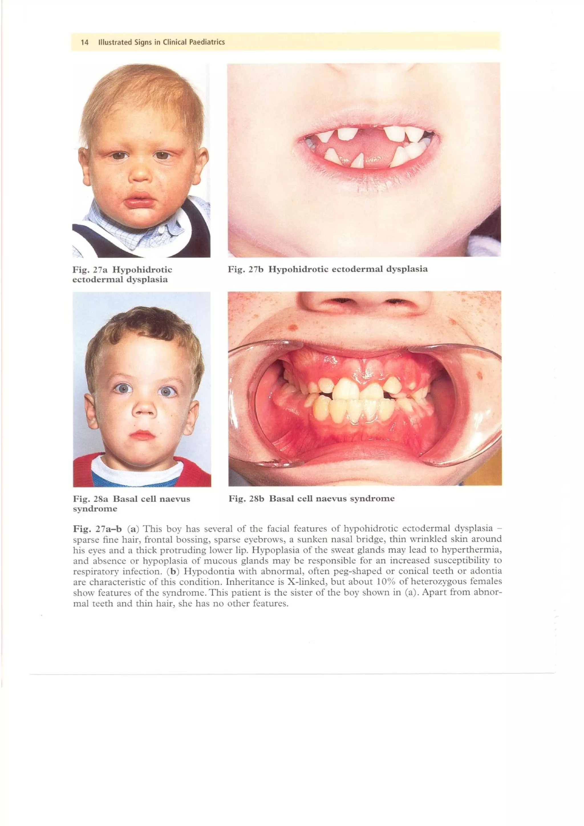 Illustrated signs in clinical pediatrics | PDF