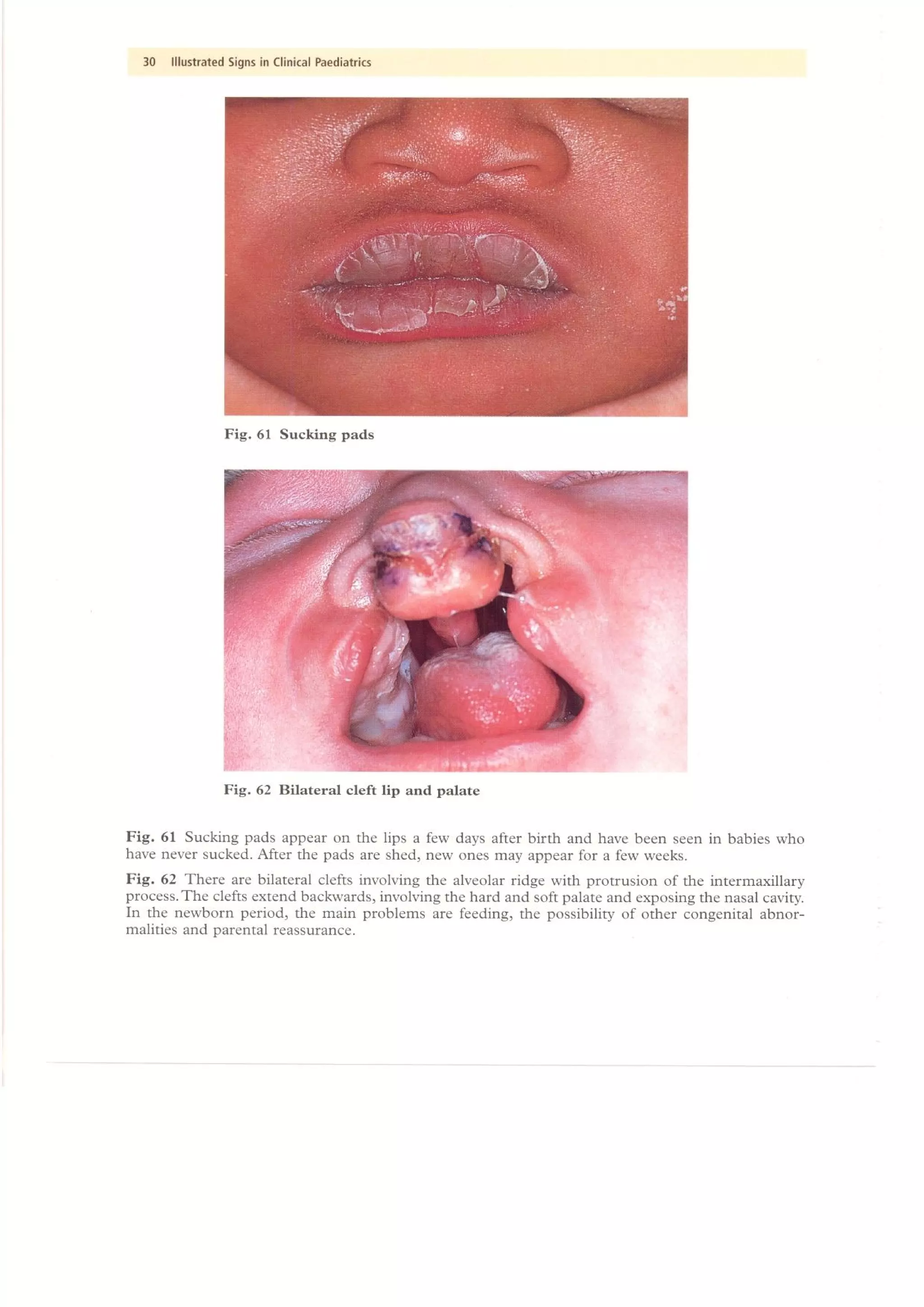 Illustrated signs in clinical pediatrics | PDF