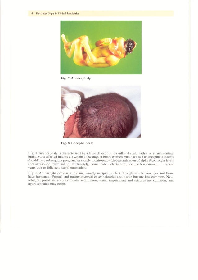 Illustrated signs in clinical pediatrics | PDF
