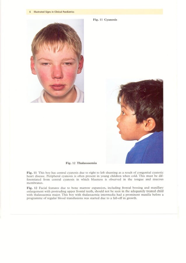 Illustrated signs in clinical pediatrics | PDF