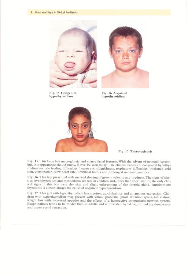 Illustrated signs in clinical pediatrics | PDF