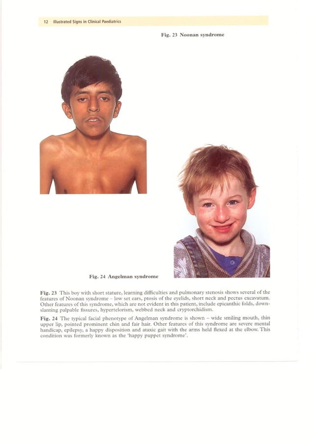 Illustrated signs in clinical pediatrics | PDF