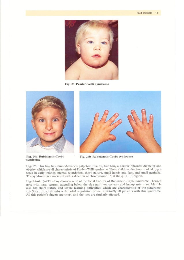 Illustrated signs in clinical pediatrics | PDF