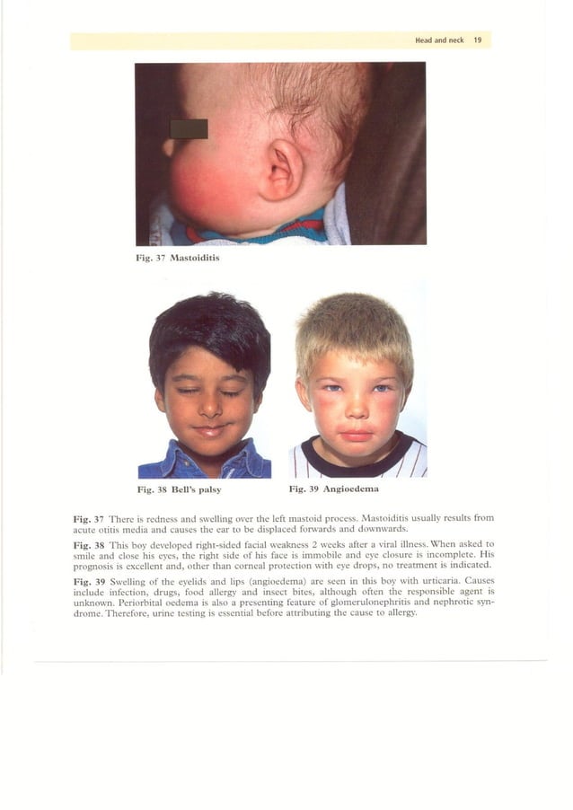 Illustrated signs in clinical pediatrics | PDF