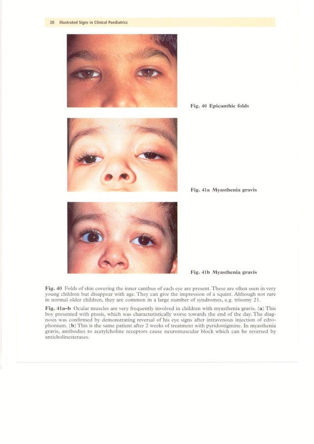 Illustrated signs in clinical pediatrics | PDF