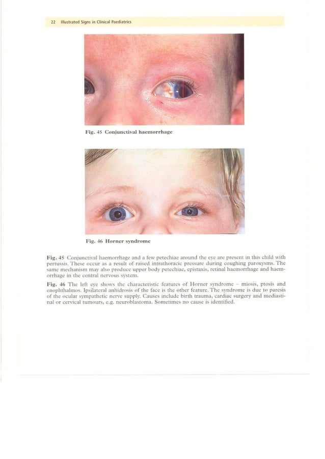 Illustrated signs in clinical pediatrics | PDF